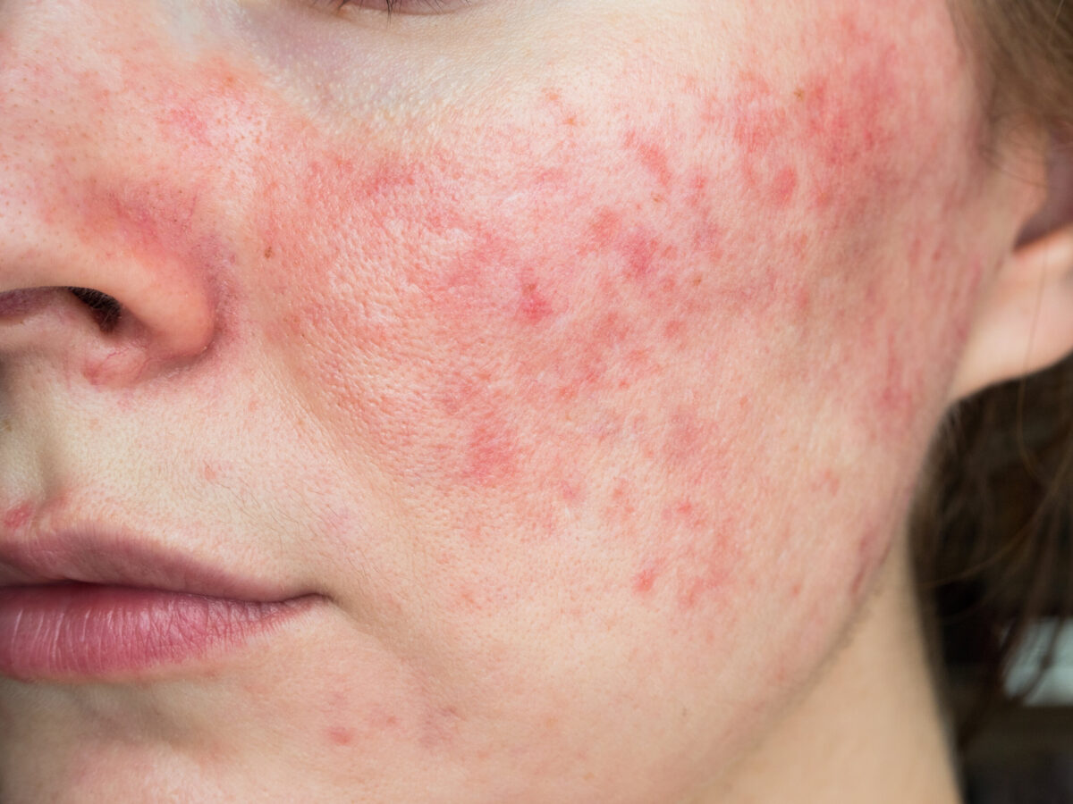 Couperose und Rosacea - Hautarztpraxis Wessendorf